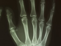 Happy X-Ray-versary, Dr. Roentgen | Plainview, NY Patch