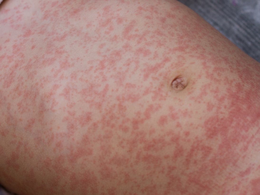 Another Measles Case Reported In North Jersey, Health Officials Warn ...