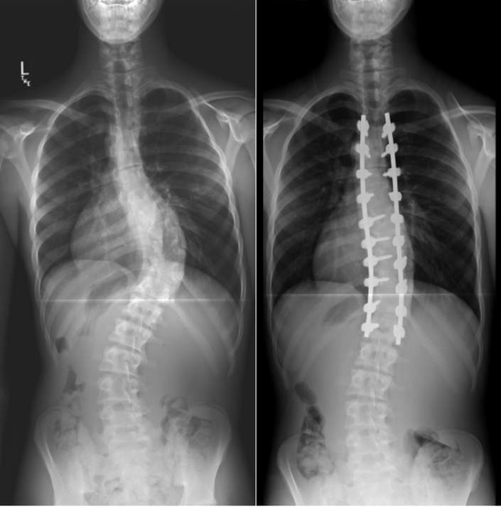 Atlantic Health System Opens Scoliosis & Spinal Deformity Center ...