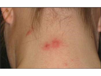 'They're Feeding On Our Skin': Black Fly Outbreak In Eastern Washington ...