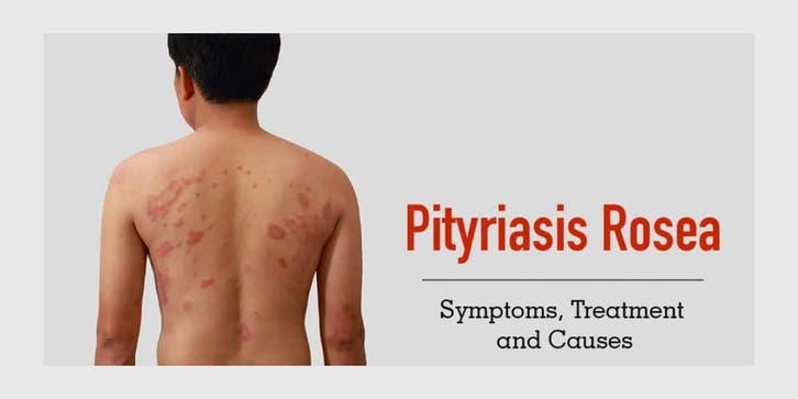 Pityriasis Rosea: Symptoms, Causes and Natural Relief - Philadelphia ...