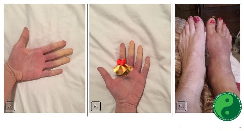 Understanding Raynaud’s Syndrome Essentials - Philadelphia, PA Patch