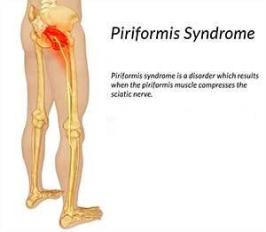Piriformis Syndrome: Causes, Symptoms & Relief - Philadelphia, PA Patch