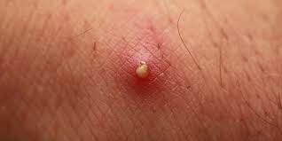 Homeopathic Treatment for Boils (FURUNCLES) - Philadelphia, PA Patch