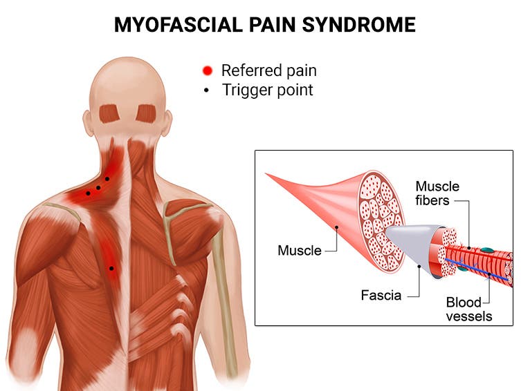 Myofascial Pain Syndrome: Symptoms, Causes, and Treatment ...