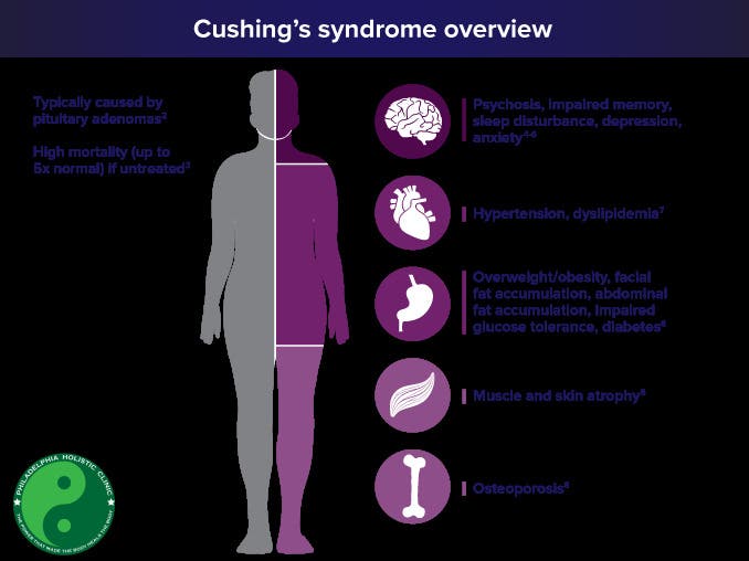 Cushing’s disease: natural treatment - Philadelphia, PA Patch