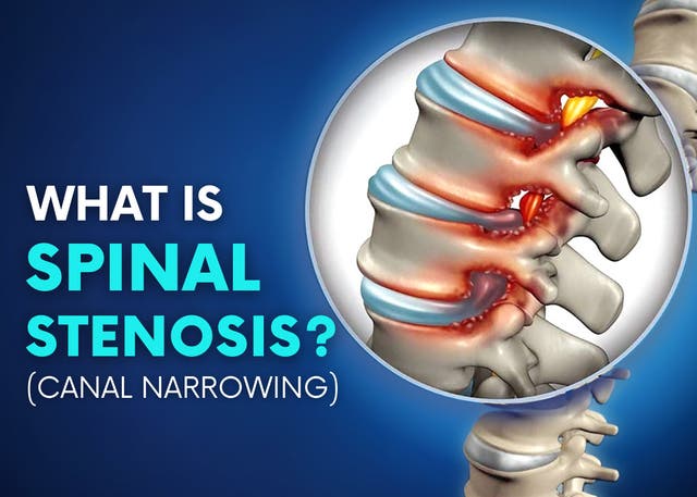 Spinal Stenosis: Causes, Symptoms, Conventional and Holistic Treatments ...