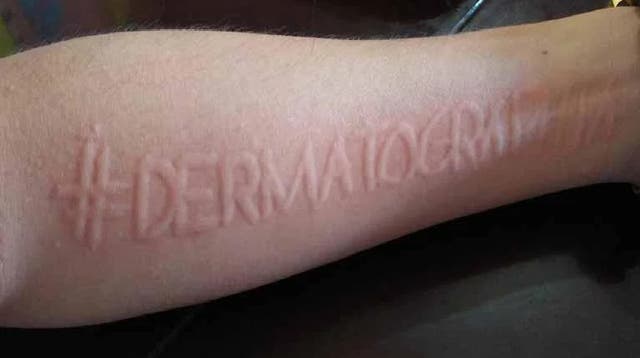 Dermatographia Disease: Understanding the Skin Disorder - Philadelphia ...