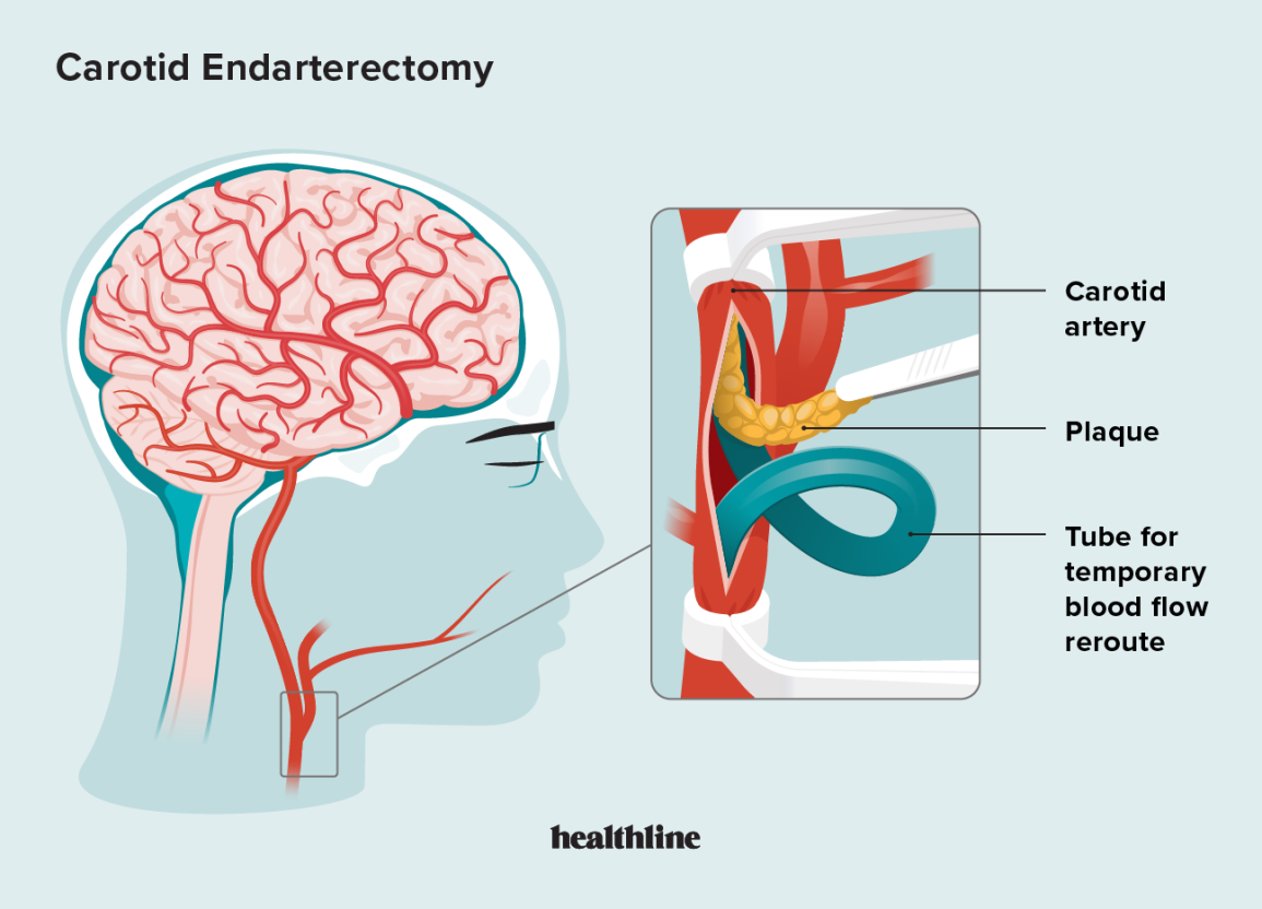 Carotid Artery Surgery: Risks, Benefits, and Recovery - Milford, CT Patch