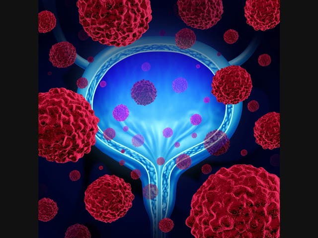 Blue Light Cystoscopy Enhances Detection of Cancer in the Bladder | New ...
