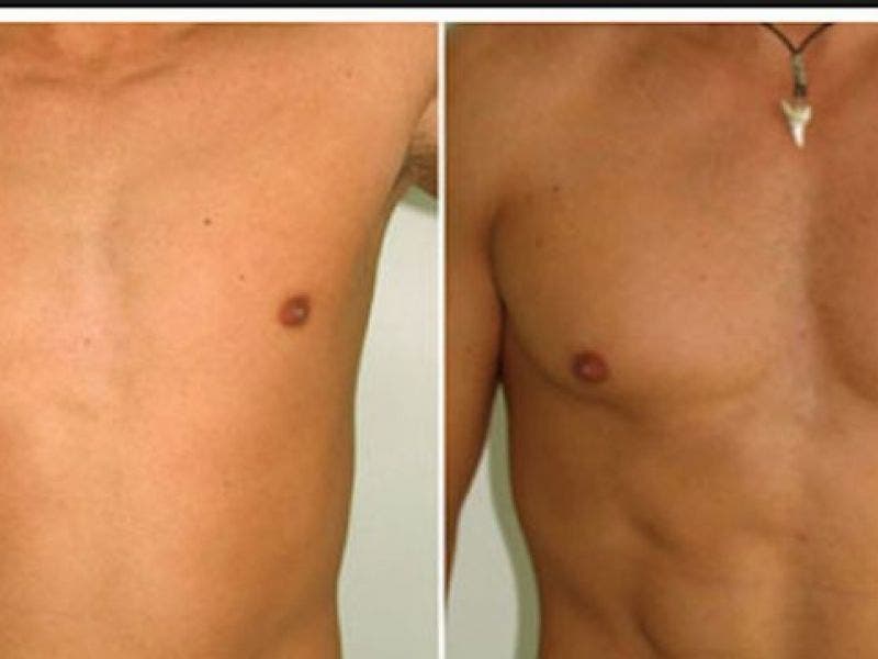 Men seeking FREE Pectoral Implants (Hollywood/L.A) (Los Angeles ...