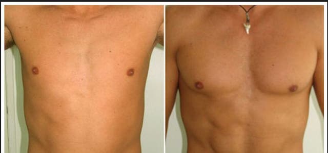 Men seeking FREE Pectoral Implants (Hollywood/L.A) (Los Angeles ...